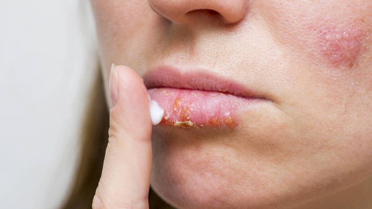 Impetigo On Mouth